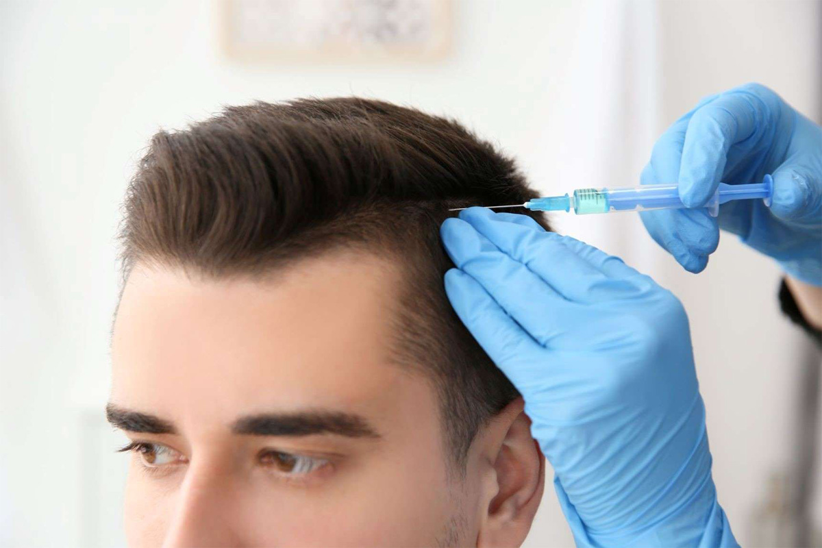 7 facteurs à considérer avant de subir une greffe de cheveux
